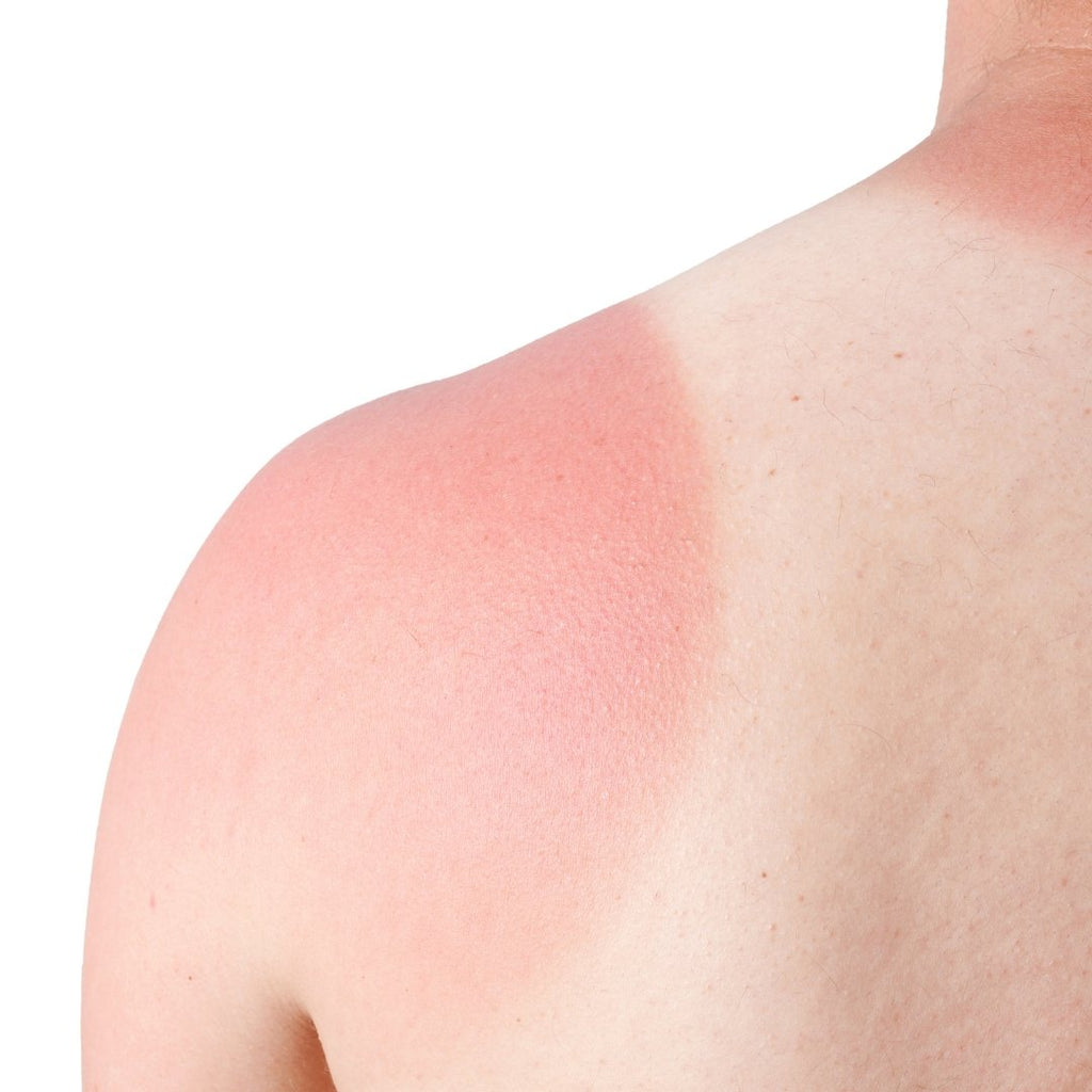 Comment soulager efficacement les coups de soleil: Guide complet et as – Novëm